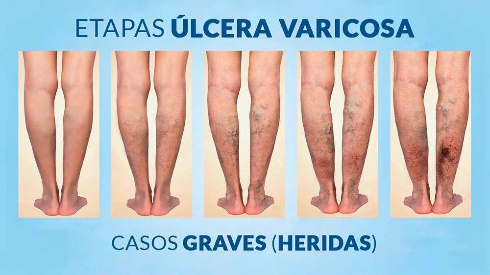 ulcera-varicosa-tratamiento-natural-goldgreen | Gold Green Tratamientos